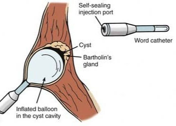 Bump on your vagina?