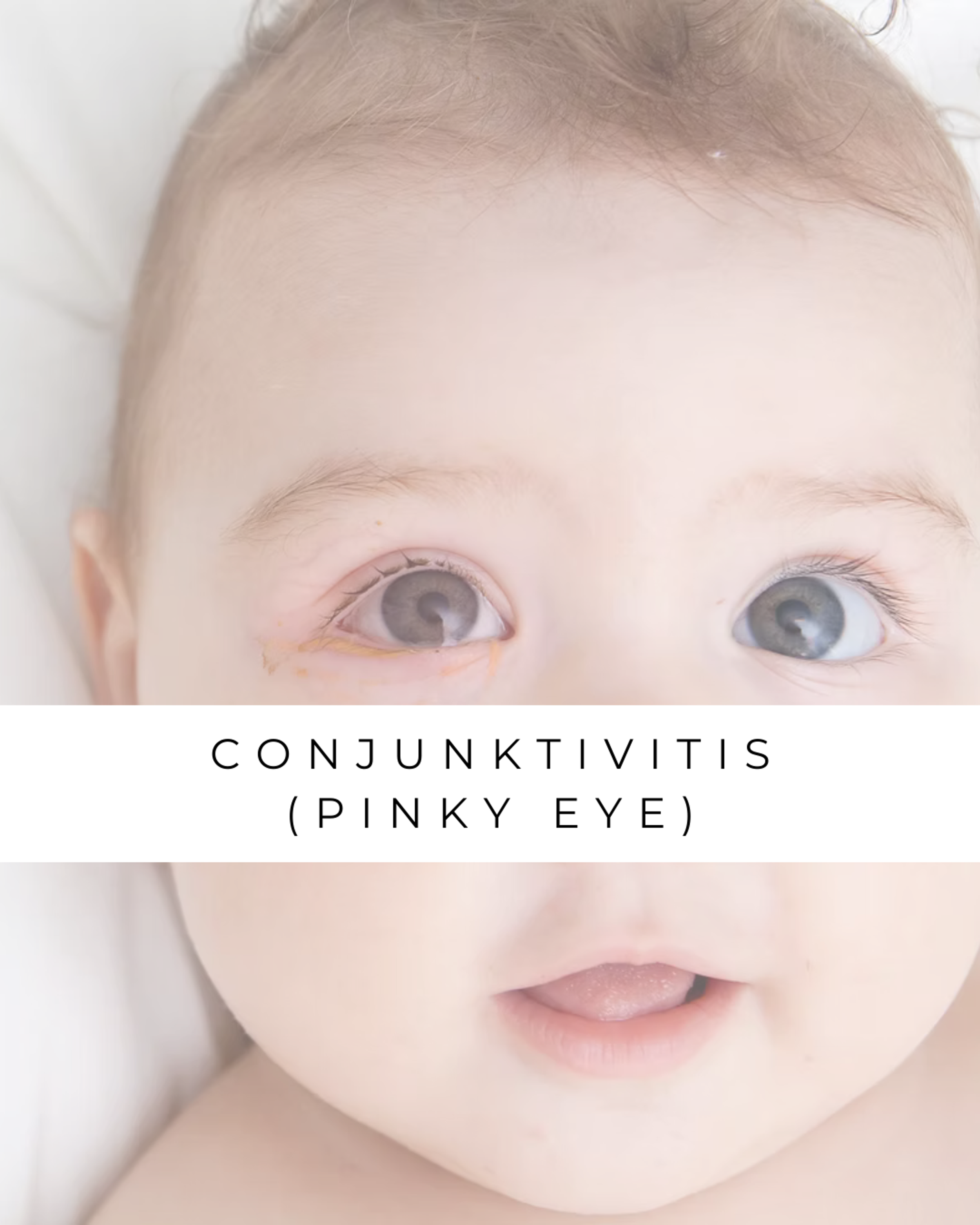 Understanding Conjunctivitis (Pink eye) in Kids: Causes and Care
