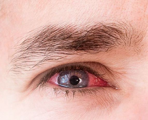 Quais as causas da hemorragia subconjuntival?