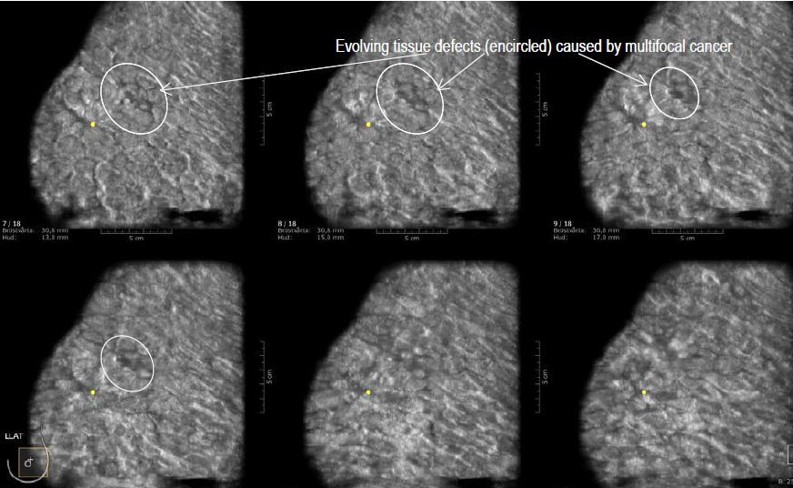 Radial Scars and Invasive Breast Cancer