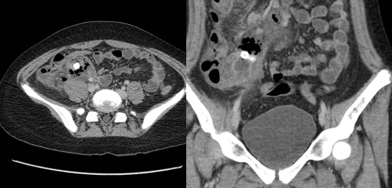 Perforated Acute Appendicitis with Percutaneous Abscess Drainage