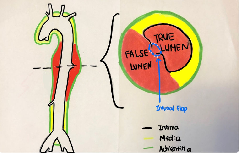 Stanford B Aortic Dissection