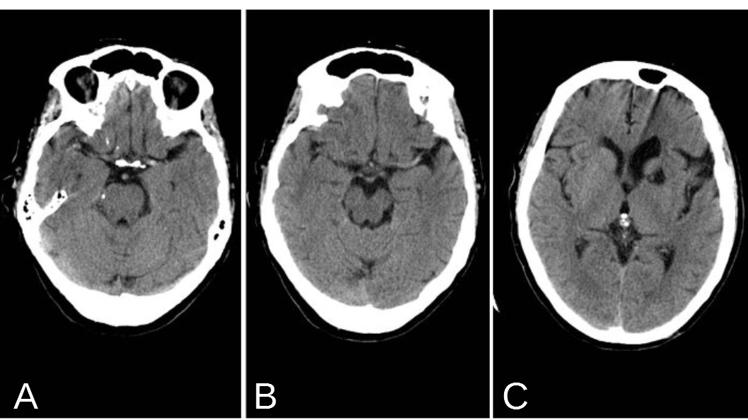 Left MCA Infarct With Hyperdense MCA Sign Left MCA Infarct With Hyperdense MCA Sign