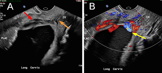 Marginal Sinus Bleeding