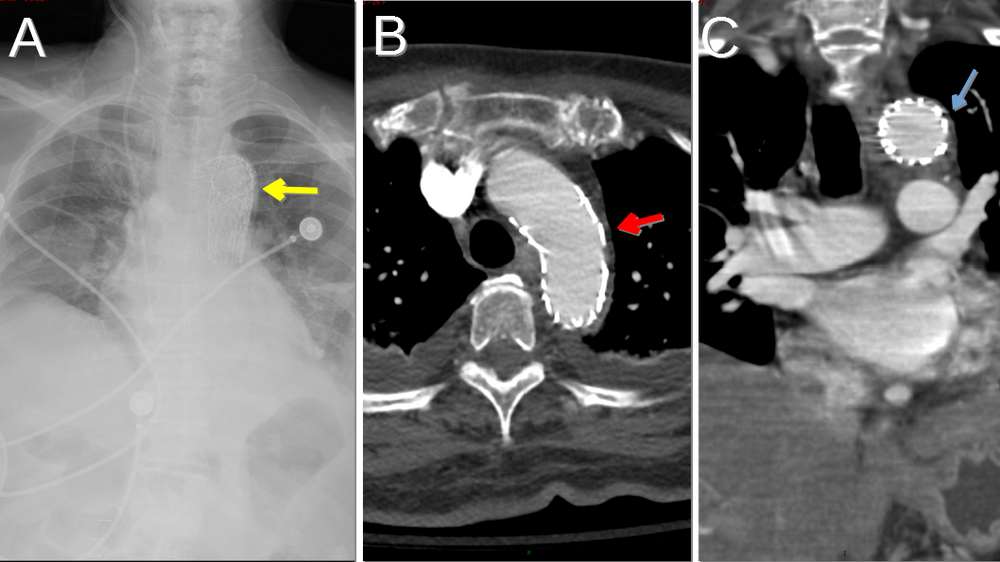 Traumatic Thoracic Aortic Injury