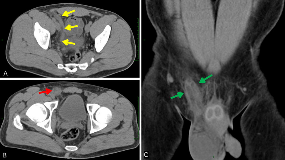Acute Infective Vasitis
