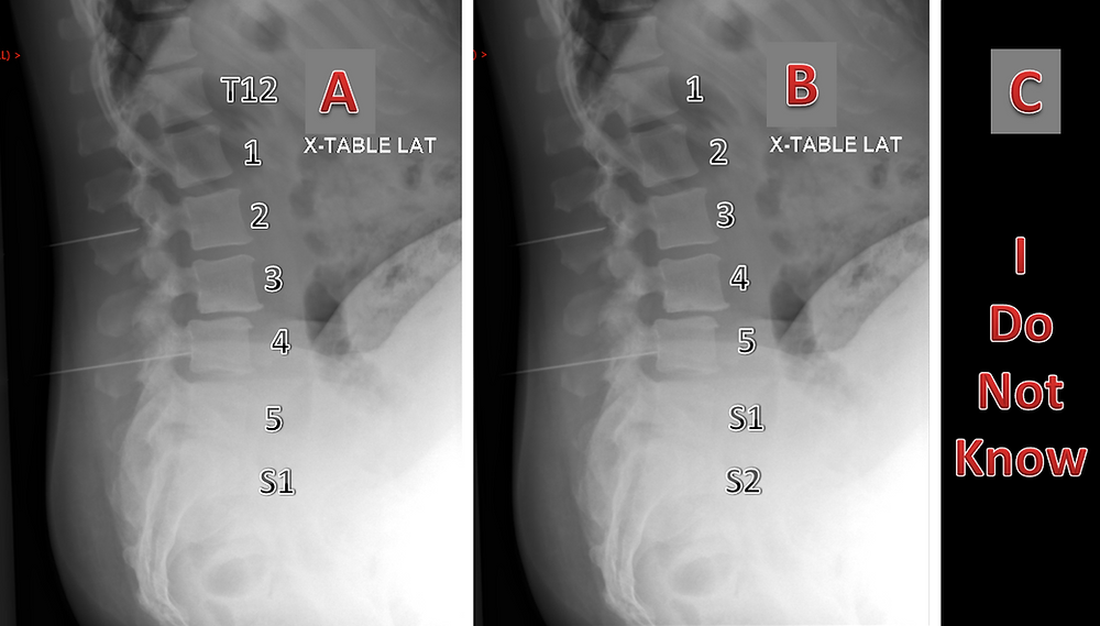 Transitional Lumbosacral Vertebra