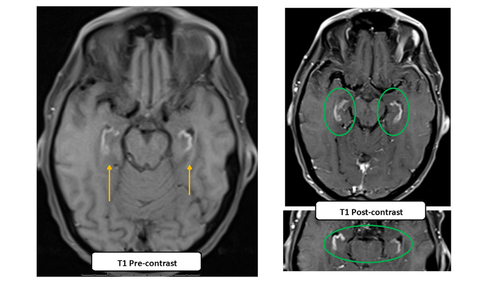 Bilateral Hippocampal Infarction