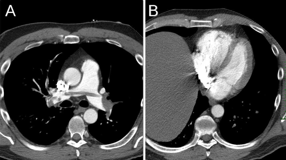 Saddle Pulmonary Embolism with RV Strain