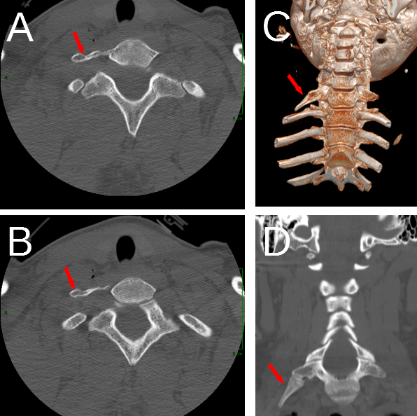 Cervical Rib