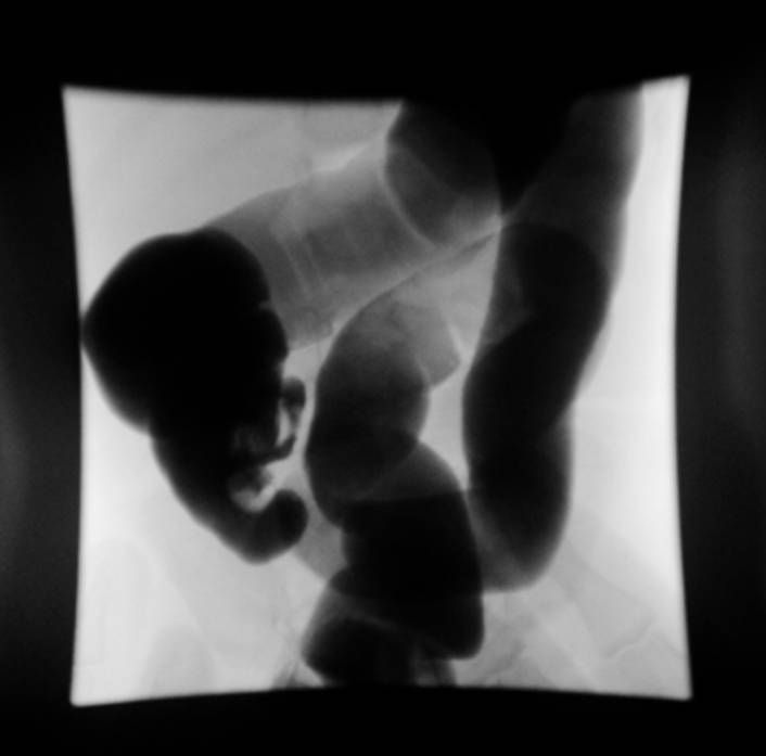 Ileo-Colic Intussusception