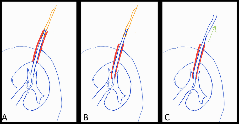 How to Exchange a Blocked Nephrostomy Tube