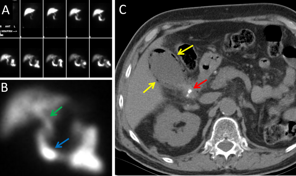 Emphysematous Cholecystitis