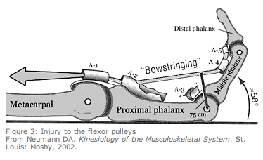Tear of the Flexor Pulley of the Finger