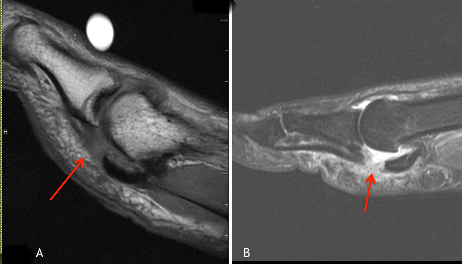 Turf Toe | Radiology Education Seminars | International | Global ...