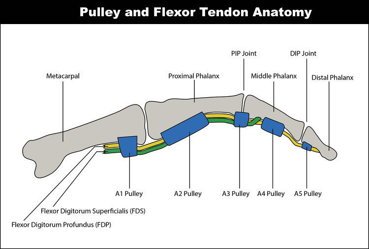 Tear of the Flexor Pulley of the Finger