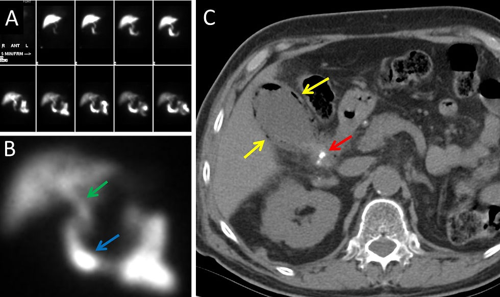 Percutaneous Cholecystostomy