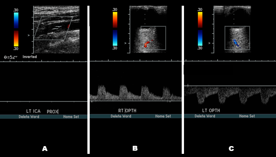 Retrograde Flow in the Left Ophthalmic Artery