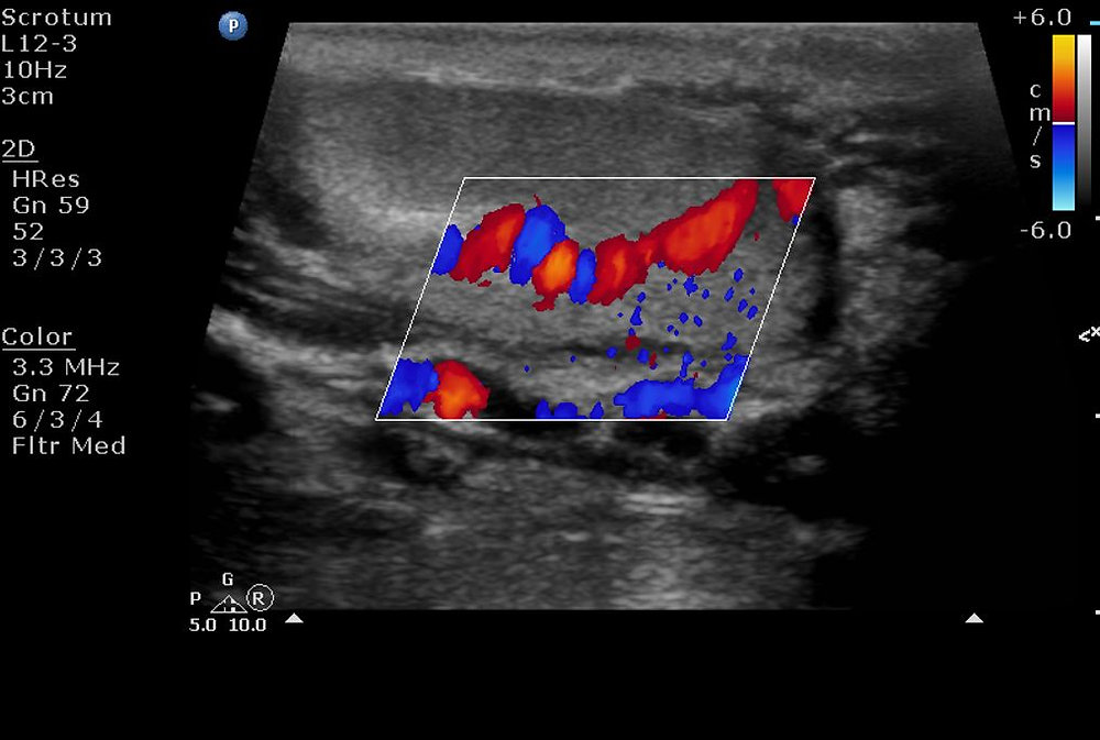 Varicocele Ultrasound Sneeze And Pop: A Ruptured Varicocele; Analysis