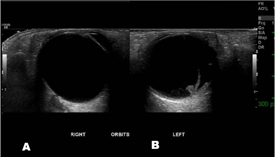 Retinal Detachment | Radiology Education Seminars | International ...