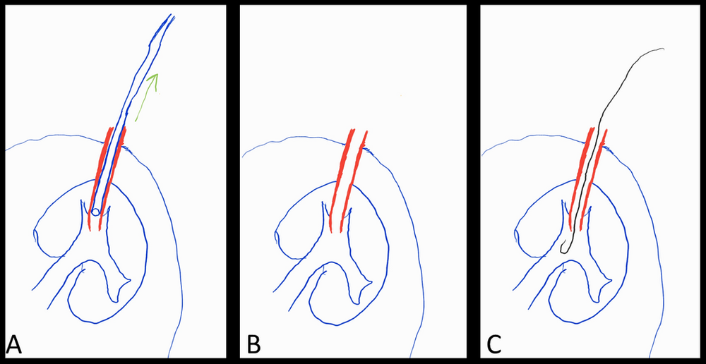 How to Exchange a Blocked Nephrostomy Tube