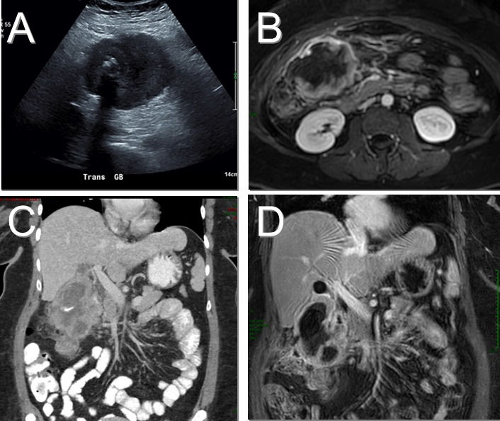 Gallbladder Carcinoma