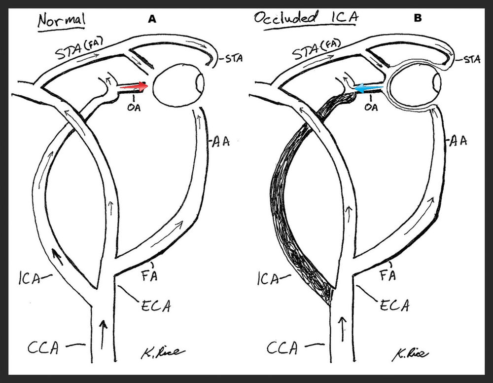 Retrograde Flow in the Left Ophthalmic Artery