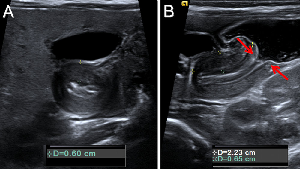 Pyloric Stenosis