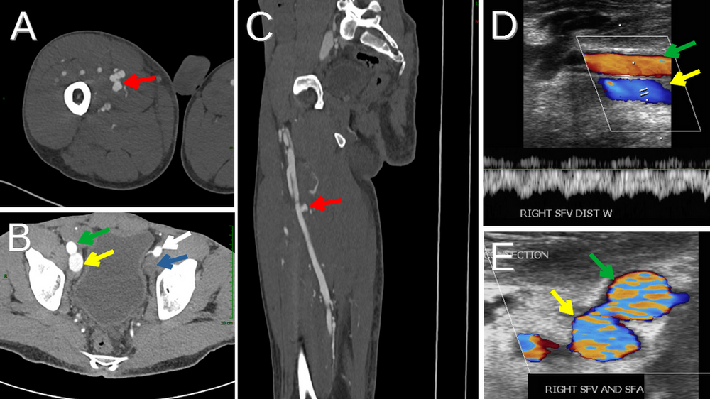 Traumatic Arteriovenous Fistula