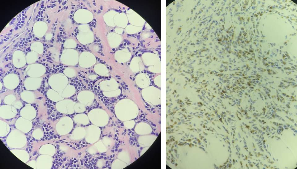 Granulocytic Sarcoma (Chloroma) in HIV/AIDS