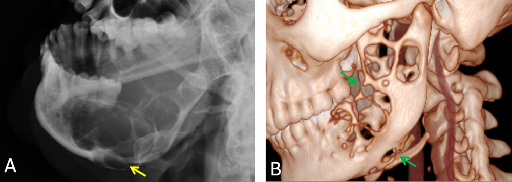 Ameloblastoma of the Mandible