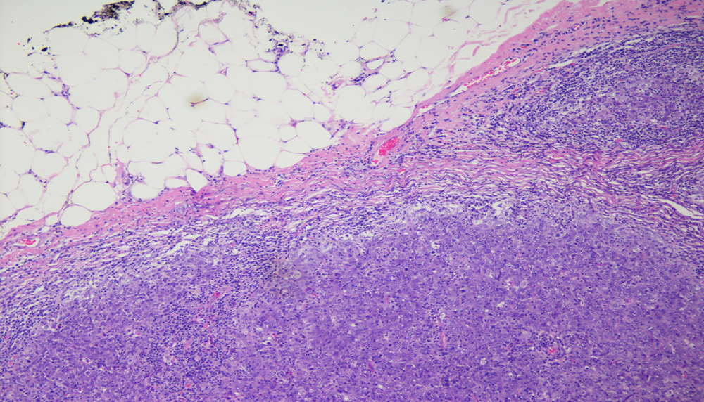 Medullary Carcinoma of the Breast