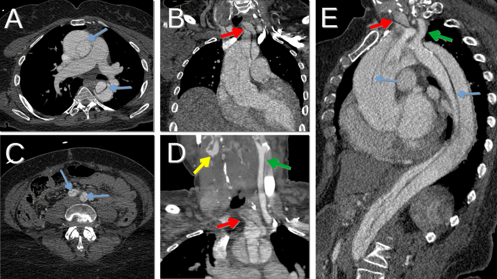 Stanford A Aortic Dissection