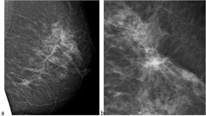 Radial Scars and Invasive Breast Cancer