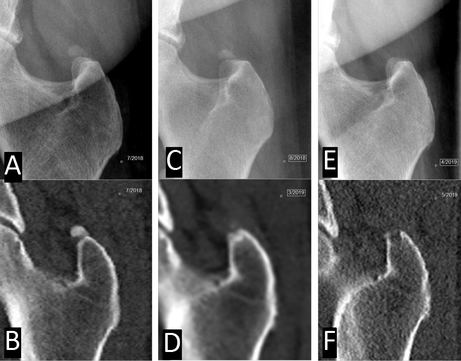 Hydroxyapatite Deposition Disease (HADD) of the Greater Trochanter