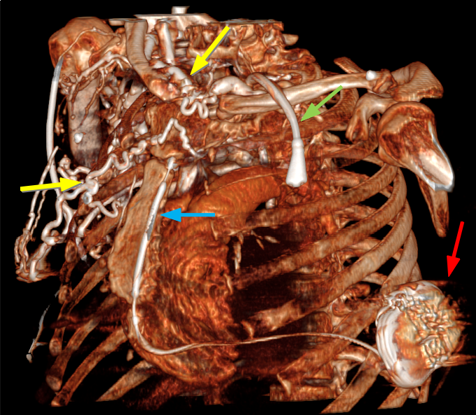 Subcutaneous Implantable Cardioverter Defibrillator