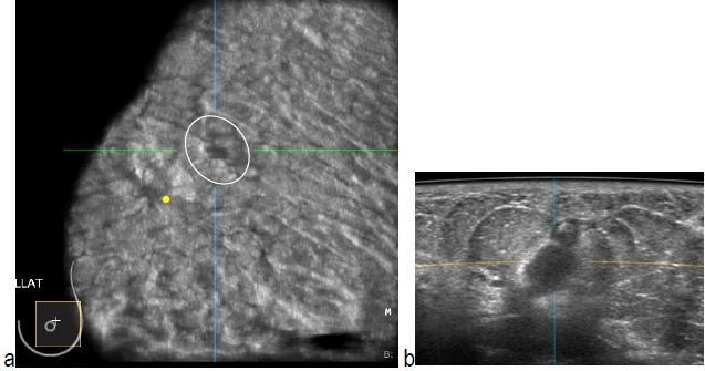 Radial Scars and Invasive Breast Cancer