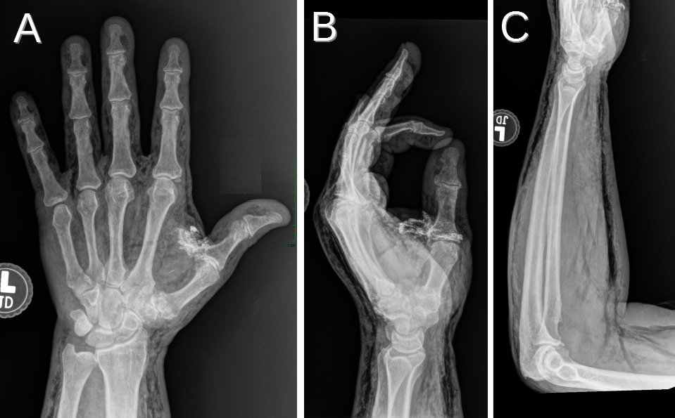 Sandblasting Injury of Hand