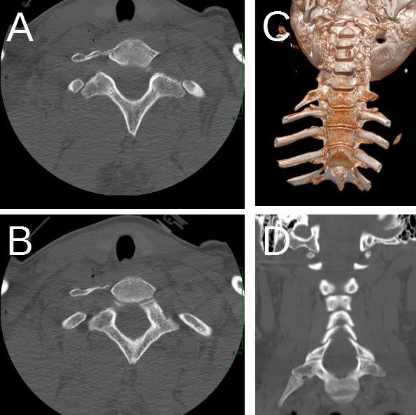 Cervical Rib