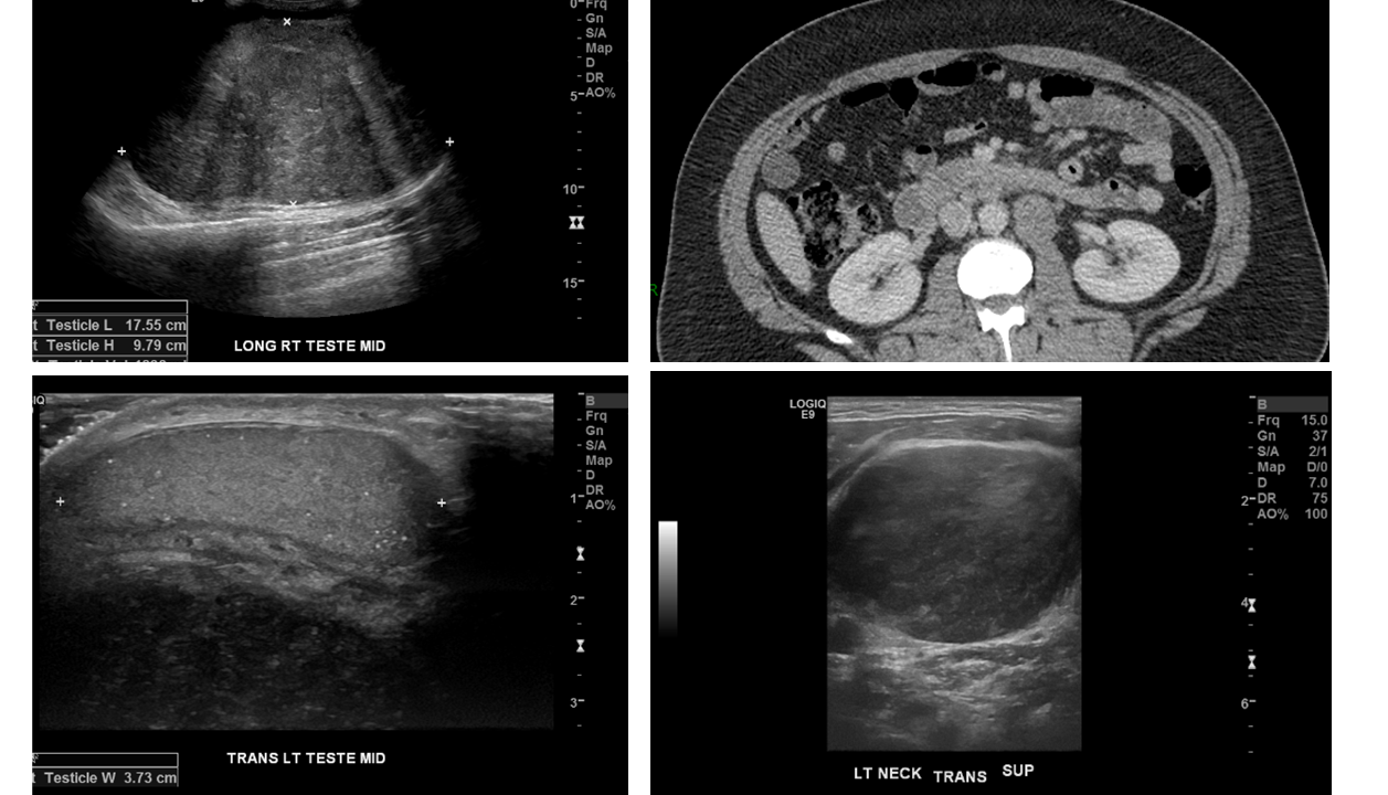 Testicular Seminoma And Testicular Microlithiasis