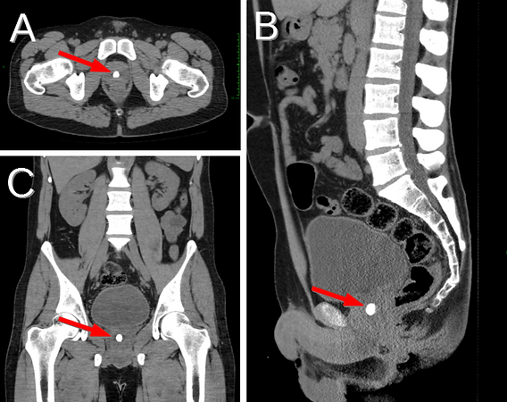 prostatic urethral calculus