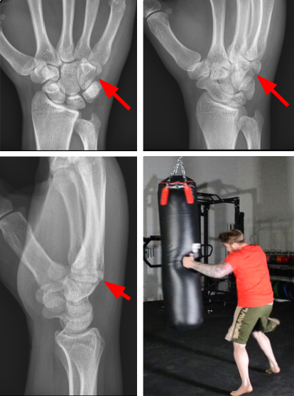 Hamate Body Fracture