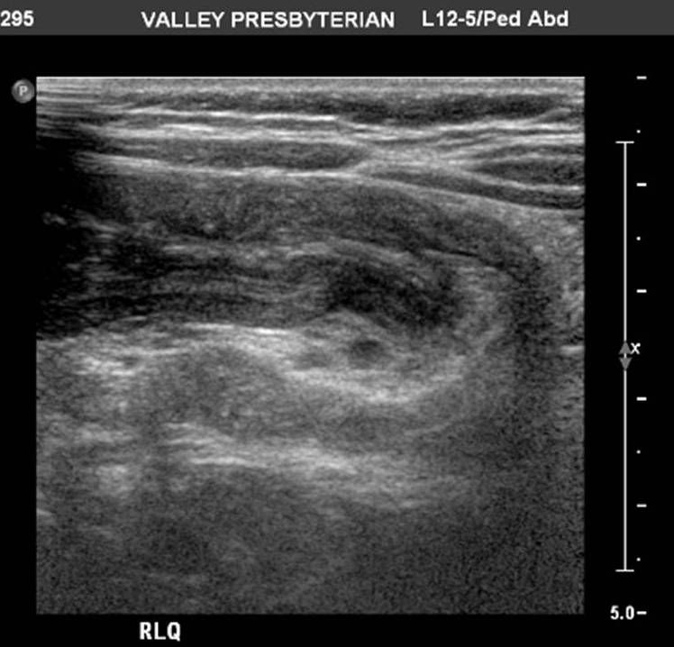 Ileo-Colic Intussusception