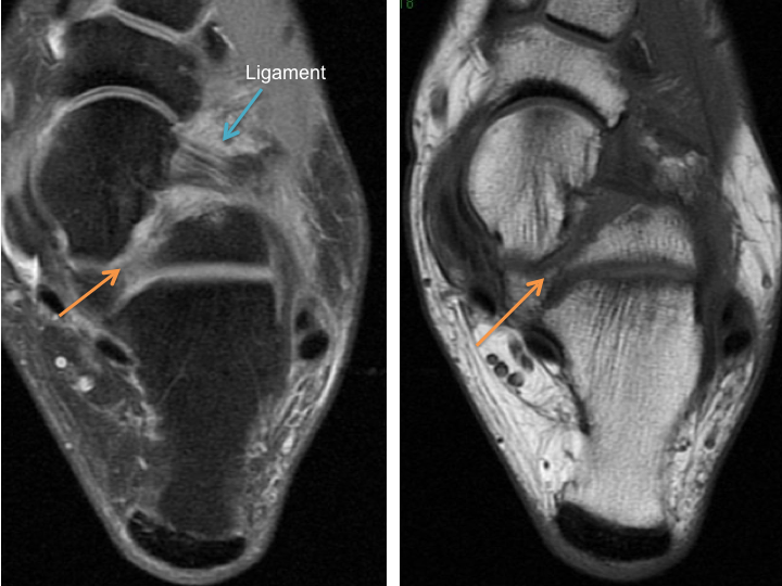 Sinus Tarsi Syndrome