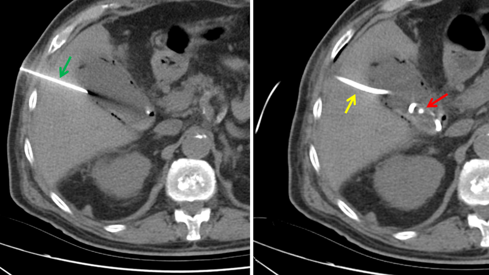 Percutaneous Cholecystostomy