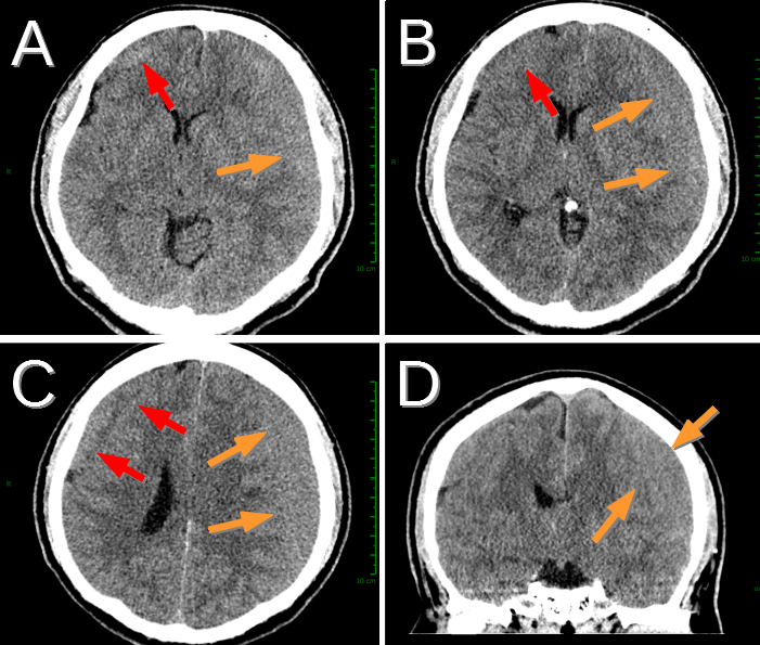 Bilateral Subacute Subdural Hematomas
