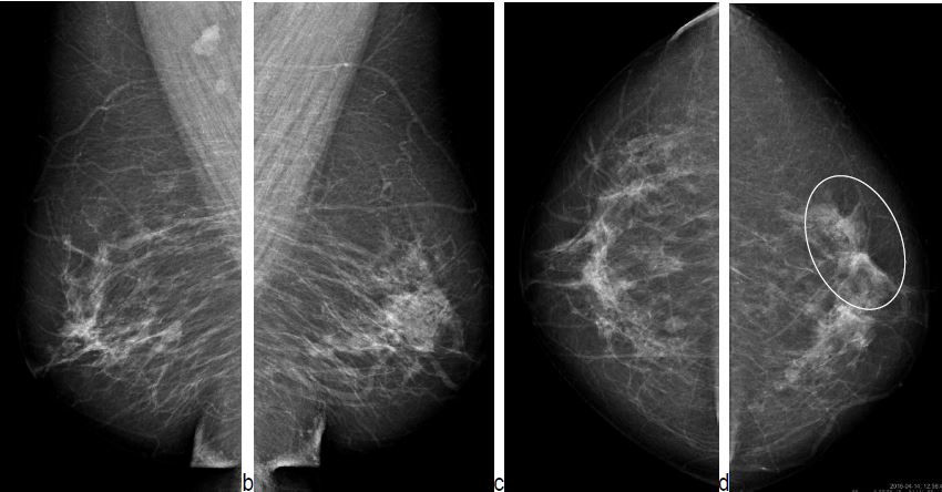 Radial Scars and Invasive Breast Cancer