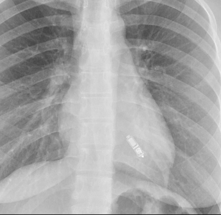 Micra Intracardiac Pacemaker