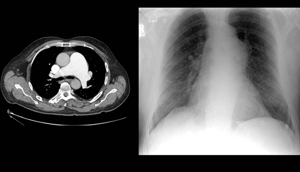 Pulmonary Artery Hypertension