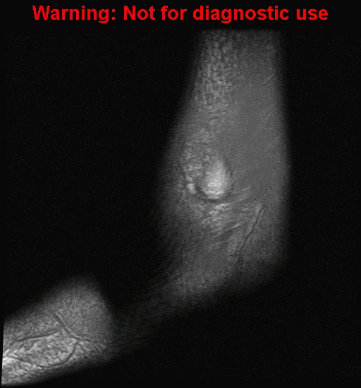 Painful Os Peroneum Syndrome (POPS)